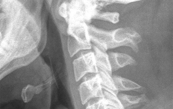 30 Year Old Male With A Complaint Of Feeling Something Stuck In His
