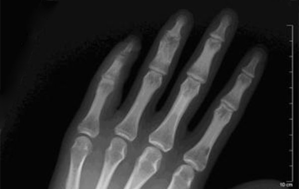23-year-old male has persistent wound after crushing finger - Journal ...