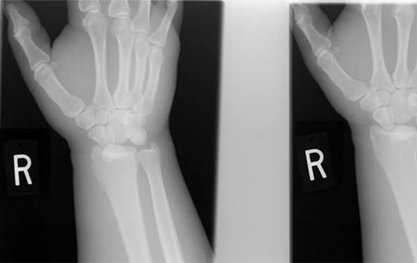 X-rays of a man who had fallen on an outstretched hand - Journal of ...