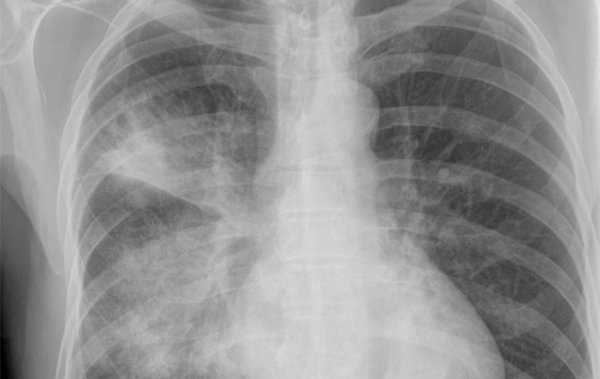 Eighteen-Year-Old with Cough and Yellow Sputum