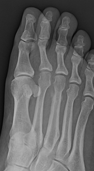 A Middle-Aged Man with Several Weeks of Midfoot Pain - Journal of ...