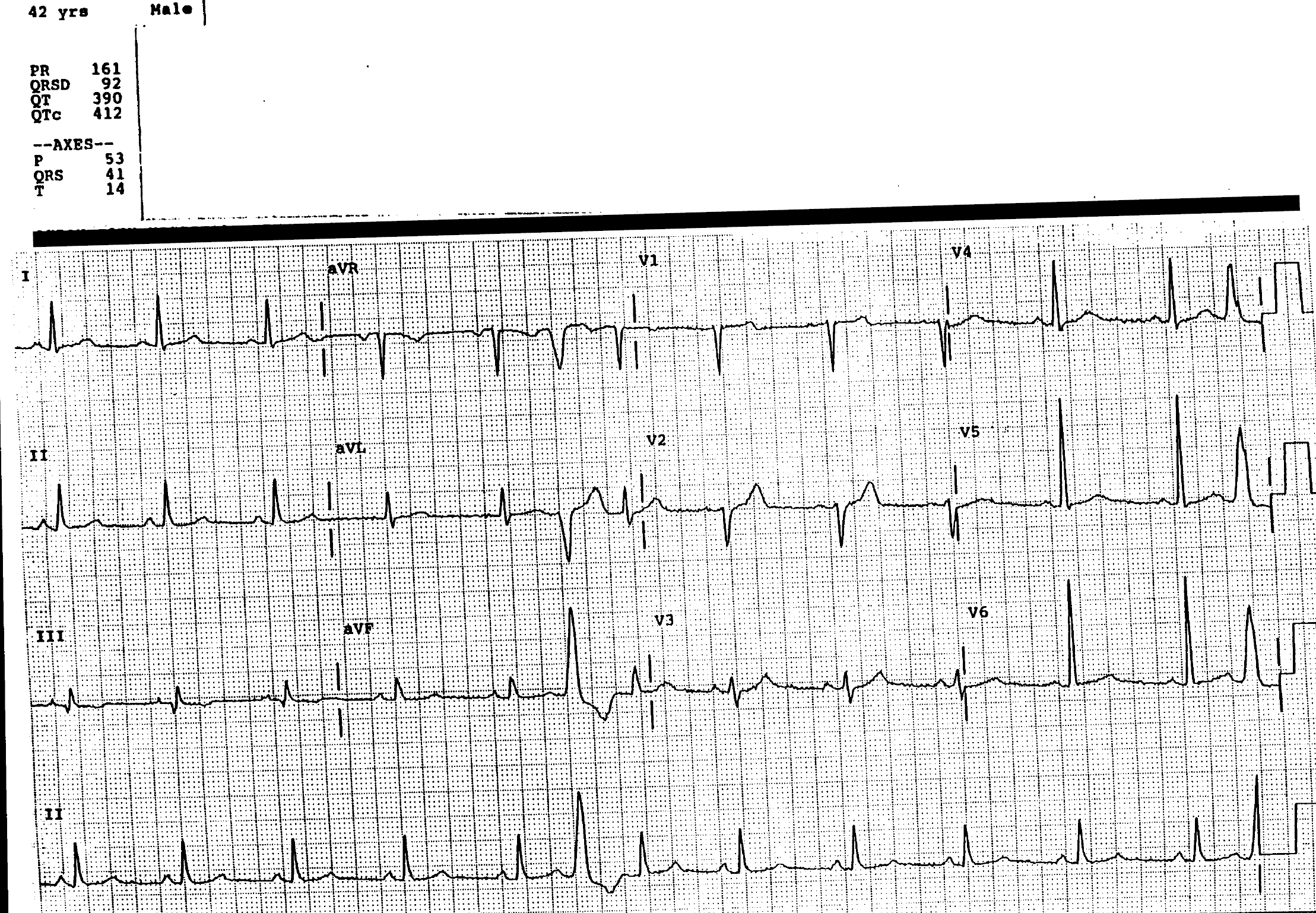 A 42-Year-Old Man with a ‘Flipping’ Sensation in his Heart - Journal of ...