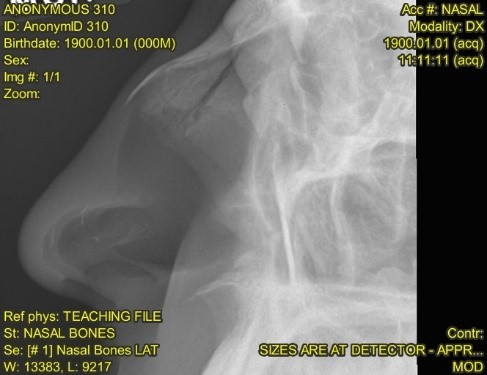 A 20-Year-Old Male with Nasal Pain Following an Injury - Journal of ...