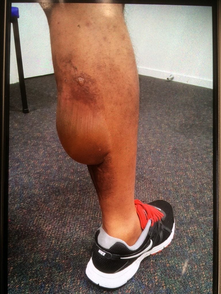 Post Sports Injury Burn Due to Inappropriate Use of Cryotherapy ...