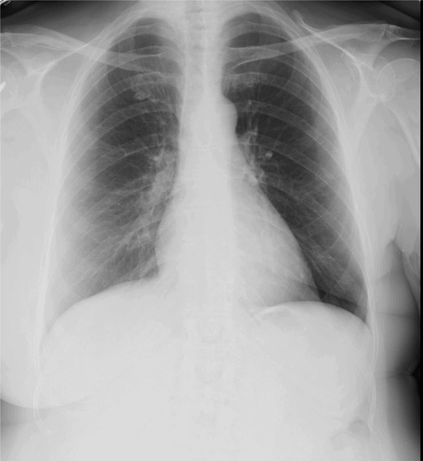 A 63-Year-Old Woman with a 4-Day History of Coughing - Journal of ...