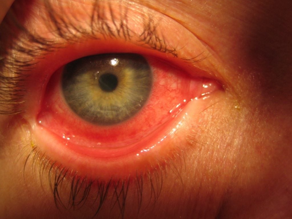 Evaluation of Infectious Conjunctivitis by Clinical Evaluation and ...