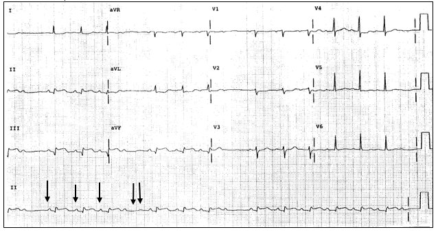 Multiple Findings Including STEMI, Low Voltage, and Type 2 AV Block in ...