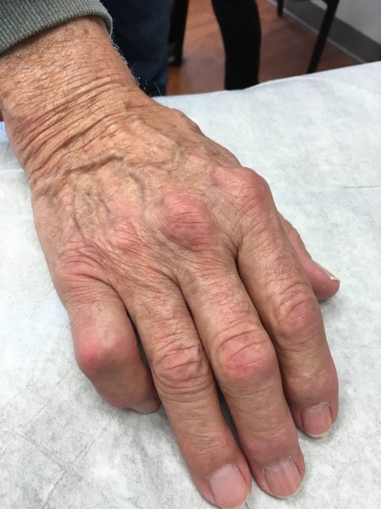 Trigger Finger Anatomy