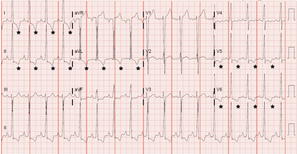 A 69-Year-Old Man with a 2-Month History of Shortness of Breath and ...