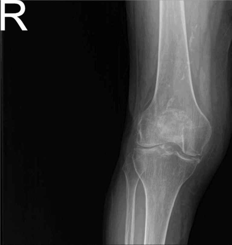 A 47-Year-Old Male with Knee Pain and Swelling After a Fall - Journal ...
