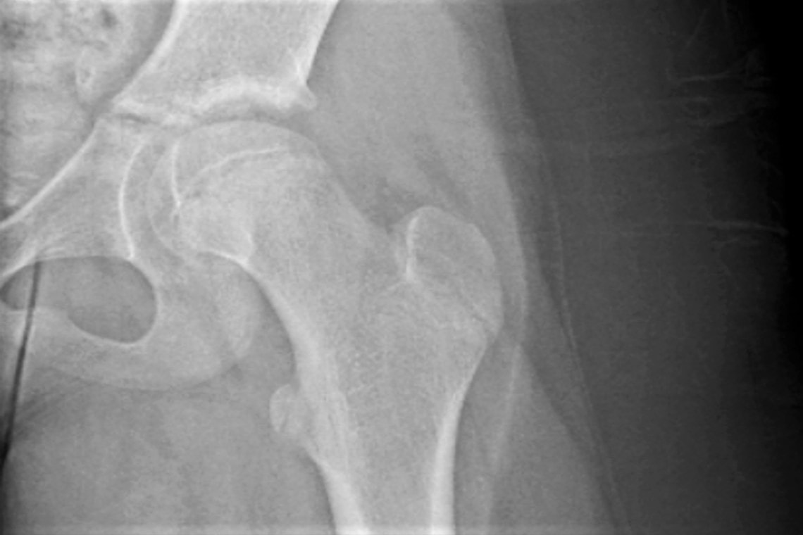 A 9-Year-Old Girl with Hip Pain After Taking a Fall - Journal of Urgent ...