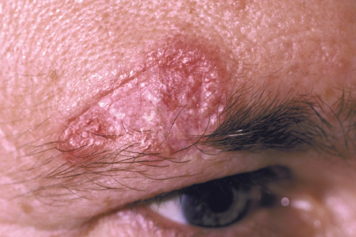 A 37 Year Old Male With An Itchy Lesion On His Face Page 2 Of 2 A 37 Year Old Male With An Itchy Lesion On His Face Page 2 Of 2