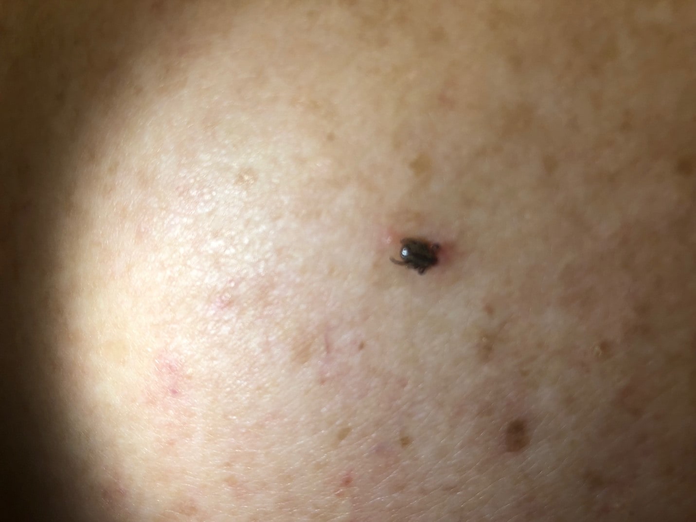 A New-Onset, Suspicious Skin Lesion - Journal of Urgent Care Medicine