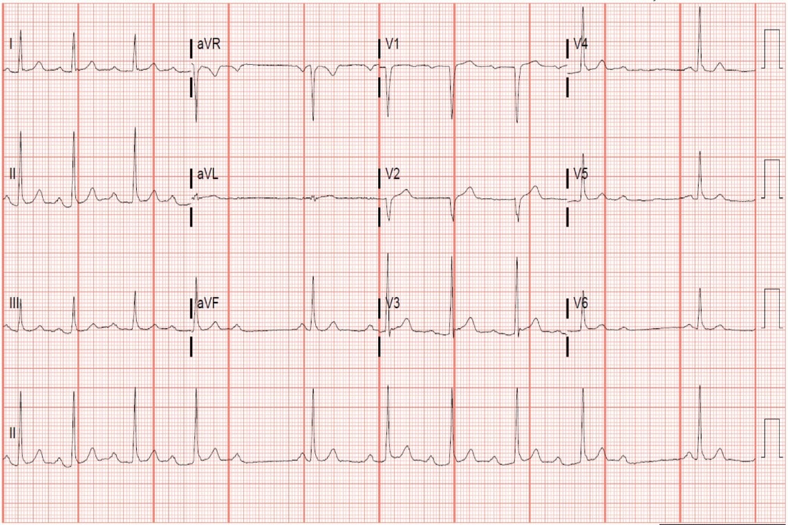 A 46-Year-Old Man with ‘Burning’ Epigastric Pain of Several Hours ...