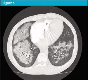 Vaping-Associated Lung Injury (EVALI) Presenting to Urgent Care ...