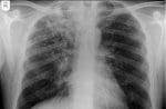 Tuberculosis: Post-Exposure Testing and Management | Journal of Urgent ...