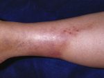 A 46-Year-Old Woman with a Painful, Erythematous Plaque on Her Leg ...