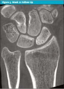 Management of Scaphoid Injuries with Early Specialized Imaging at ...