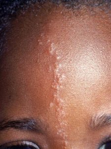 A 9-Year-Old Girl with a New Rash on Her Face - Page 2 of 2 - Journal ...