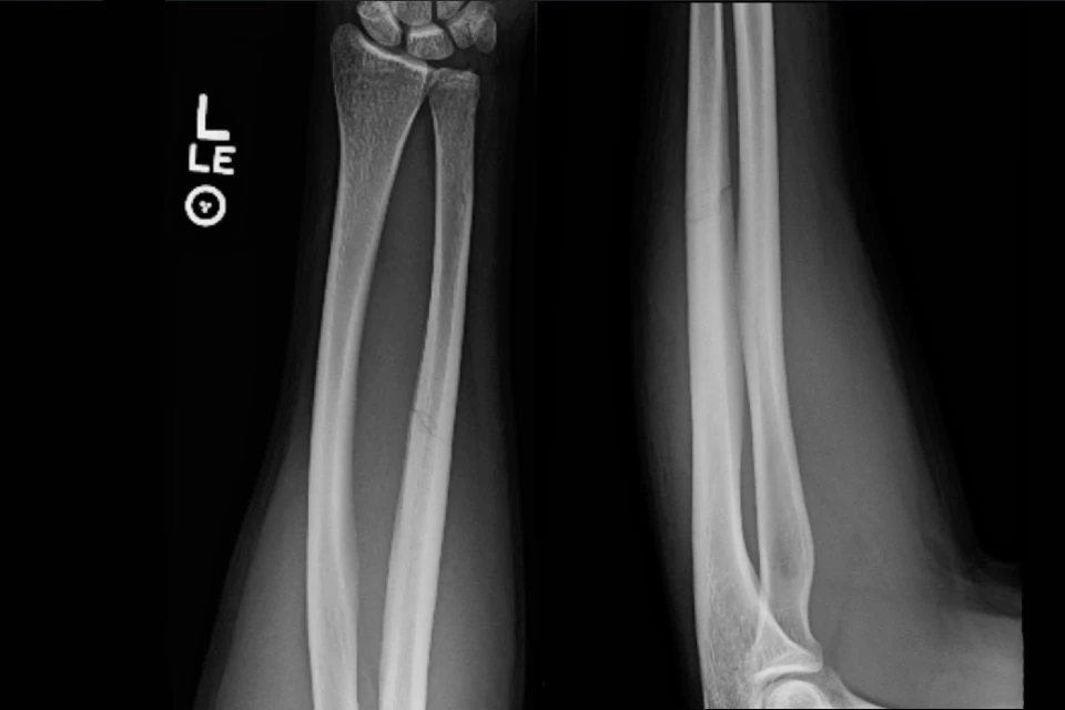 Urgent Care Diagnosis and Management of Midshaft Ulnar (Nightstick ...