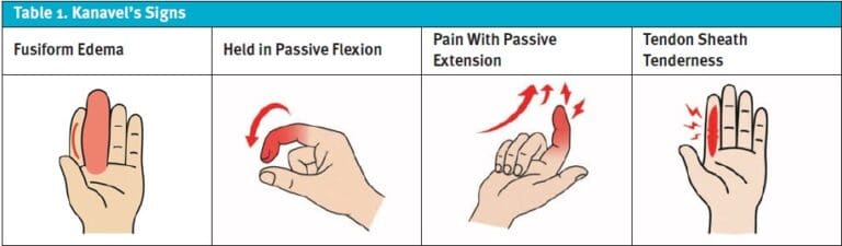 High-Pressure Paint Gun Finger Injury: A Case Report - Journal of ...